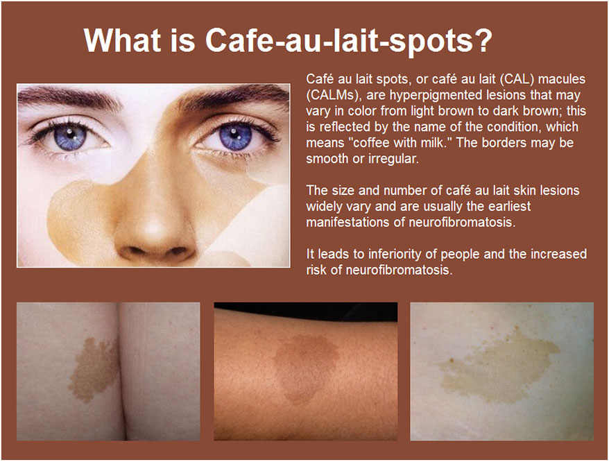 Skin Beauty Color Spot Removal Cafe au lait Spots Plastic Surgery
